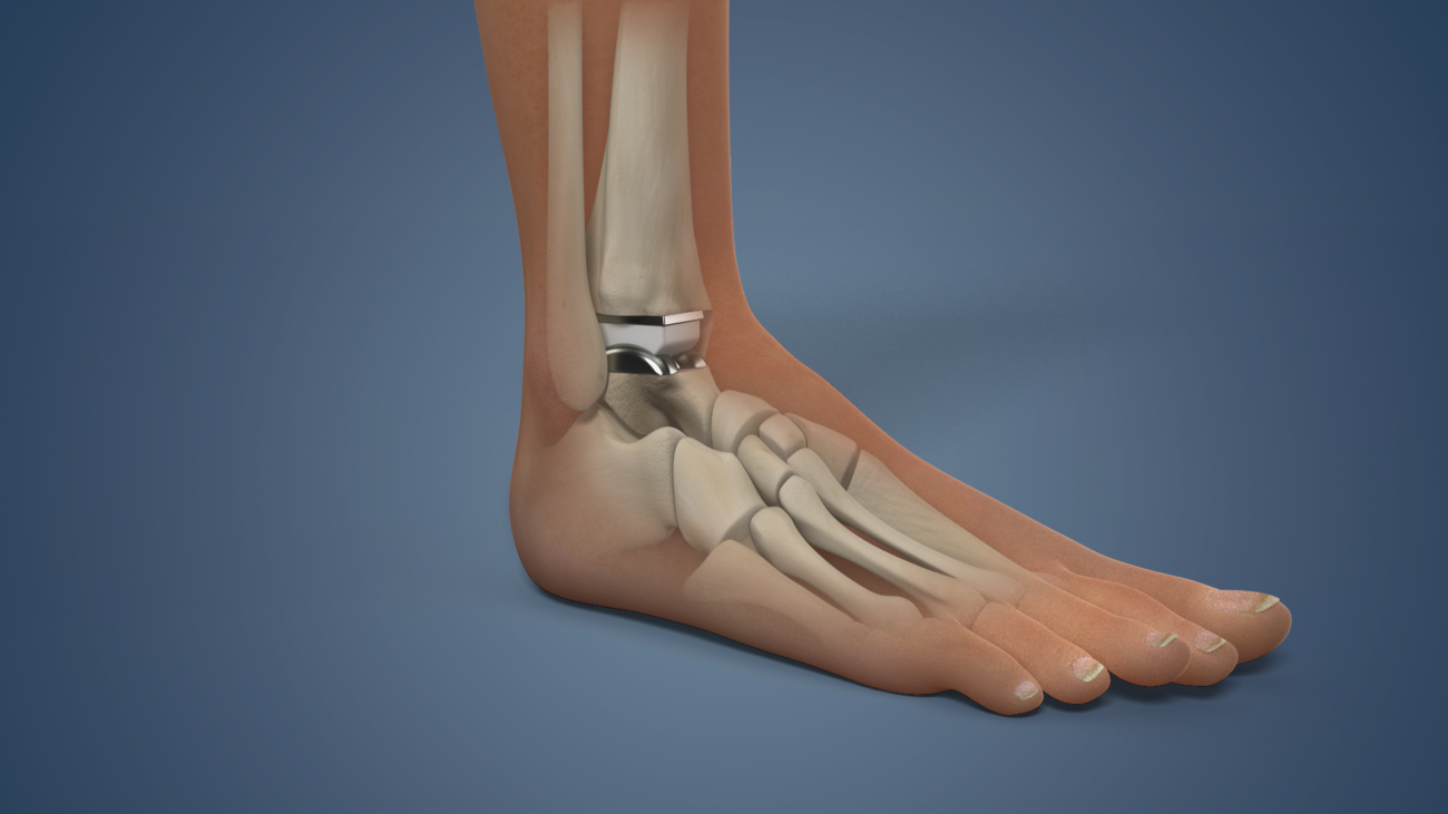 Total Ankle Replacement - Ankle & Foot Clinic-Diabetes Foot clinic India