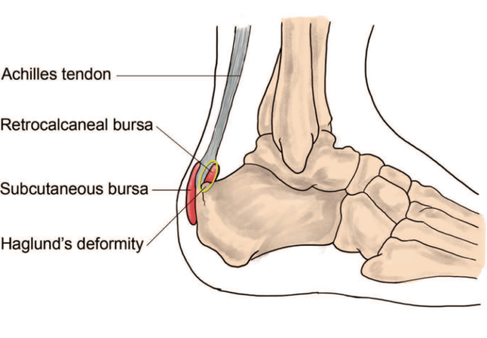 Retrocalcaneal Bursitis - Ankle & Foot Clinic-Diabetes Foot clinic India
